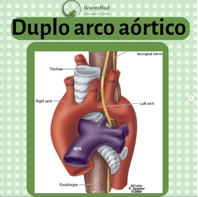 Duplo arco aórtico | Mensagens do blog por Sheyla Pereira | wavesmed