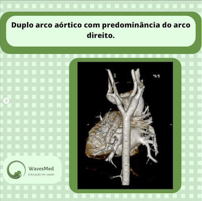 Duplo arco aórtico | Mensagens do blog por Sheyla Pereira | wavesmed